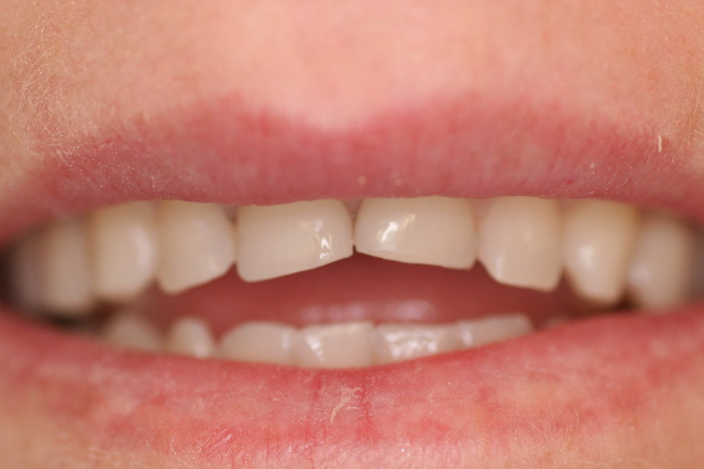 reverse smile line before - BelleDental