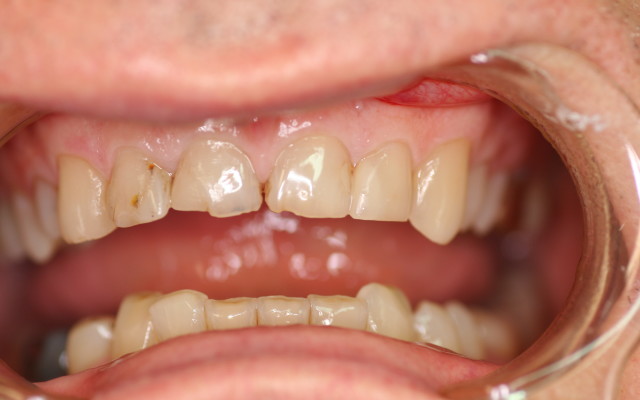 Build-ups in a day | Smile gallery | Case Study | BelleDental Newcastle