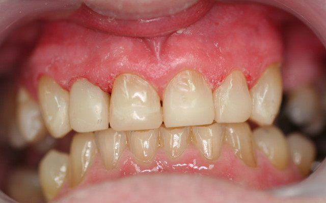 Build-ups in a day | Smile gallery | Case Study | BelleDental Newcastle