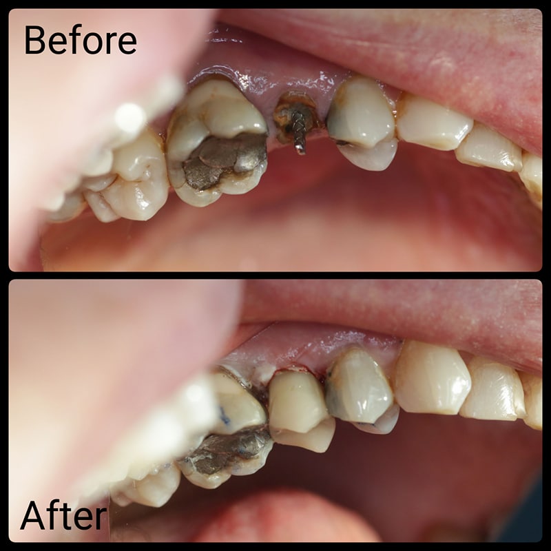 Crown or Tooth?? - BelleDental - March 11, 2019