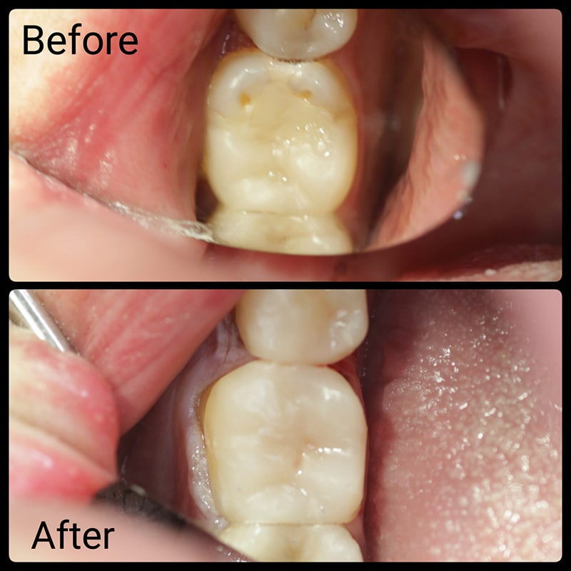 Crowns (CRC) | Case Studies | BelleDental Newcastle