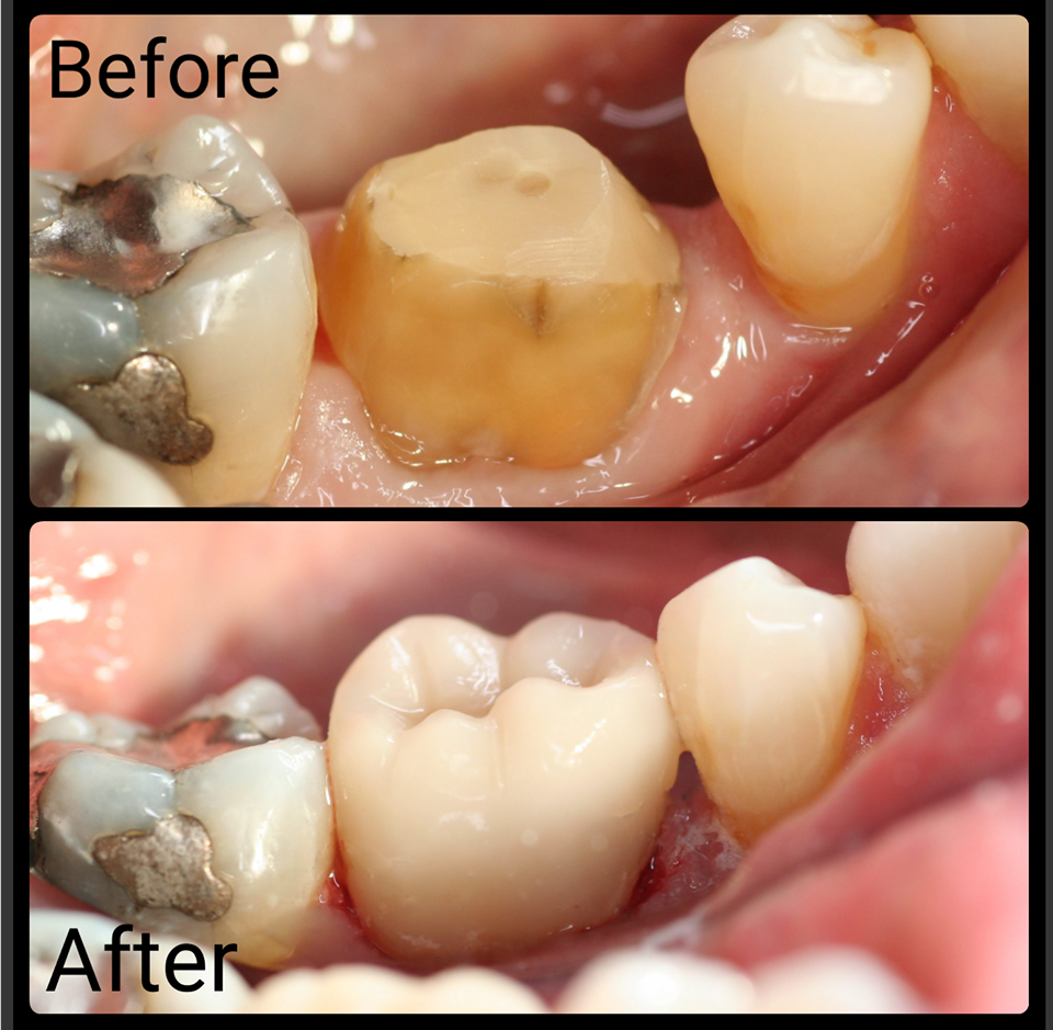 Crowns (CRC) | Case Studies | BelleDental Newcastle