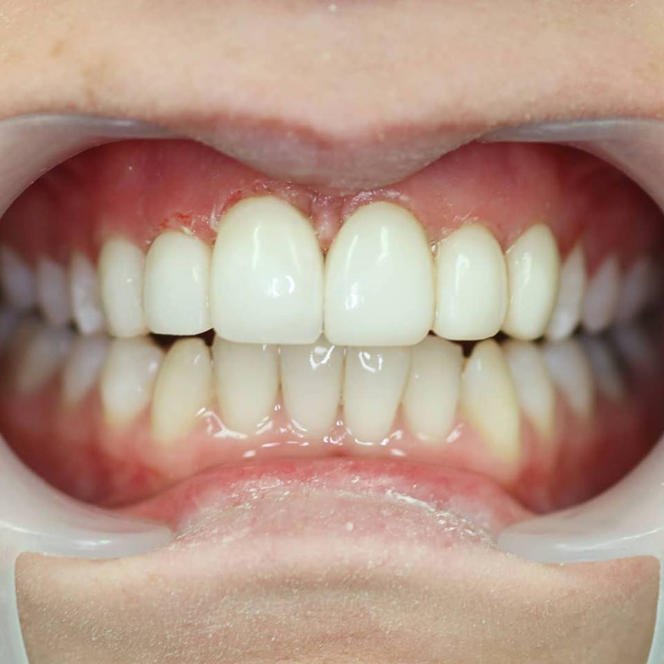 The Perfect Smile - BelleDental - June 20, 2018