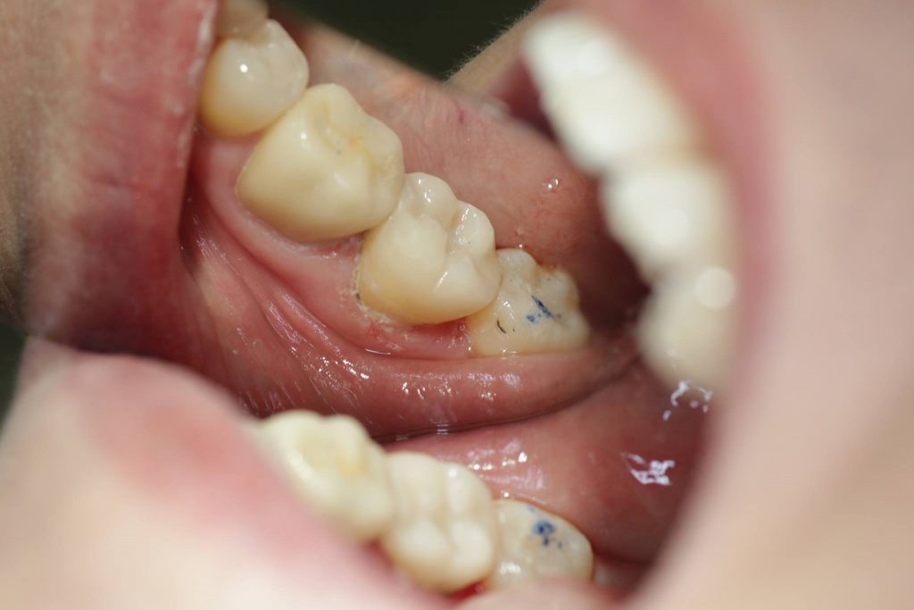 Benefits of a BelleDental CRC are as follows: - BelleDental - Dental ...