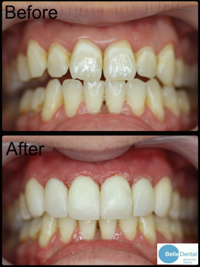 Transformation Tuesday ? #belledental - BelleDental - May 7, 2019