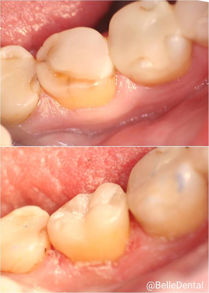 Transformation Tuesday ? #belledental - BelleDental - October 8, 2019