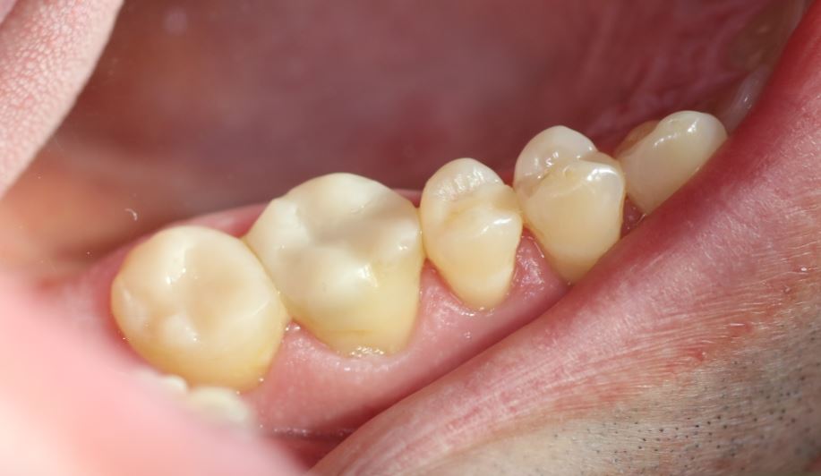 Save tooth structure - Save money - Save time!! - BelleDental - Dental ...