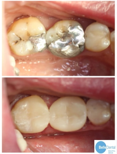 BelleDentals CRCs - BelleDental - March 4, 2020