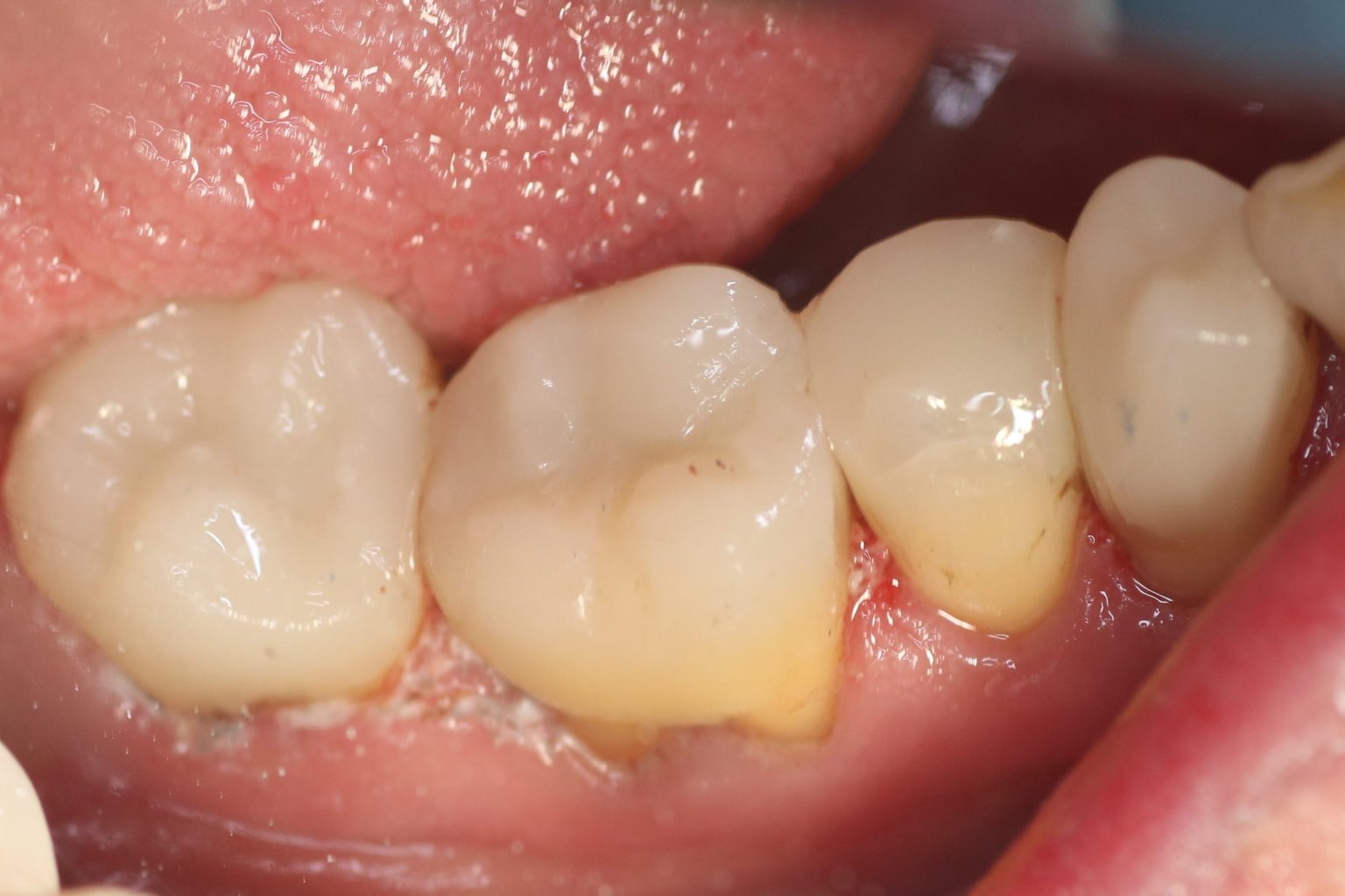 BelleDental CRCs (Composite Resin Crowns) - BelleDental - November 30, 2020