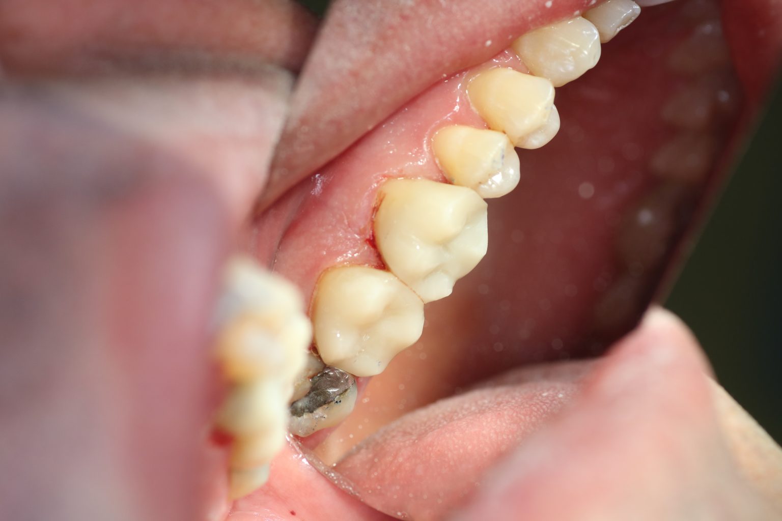 CRCs – Composite Resin Crowns - BelleDental - May 10, 2021