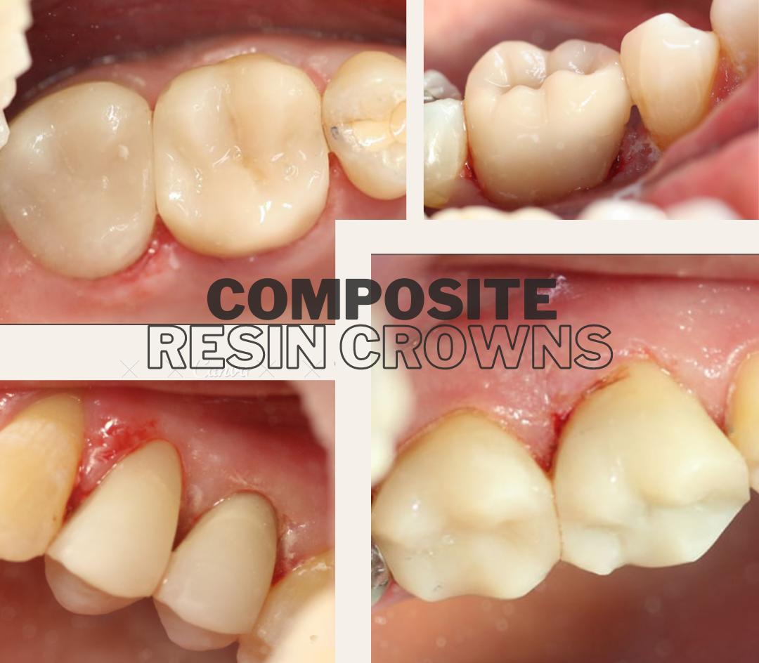 SAVE TIME, SAVE MONEY and SAVE YOUR TEETH - BelleDental - November 17, 2023 SAVE TIME, SAVE MONEY and SAVE YOUR TEETH - BelleDental - November 17, 2023
